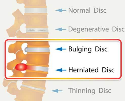 Disc Bulge vs. Disc Herniation - Which Is Worse?